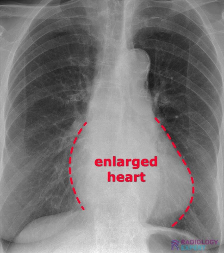 Chest X-ray