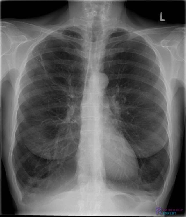 Chest X-ray