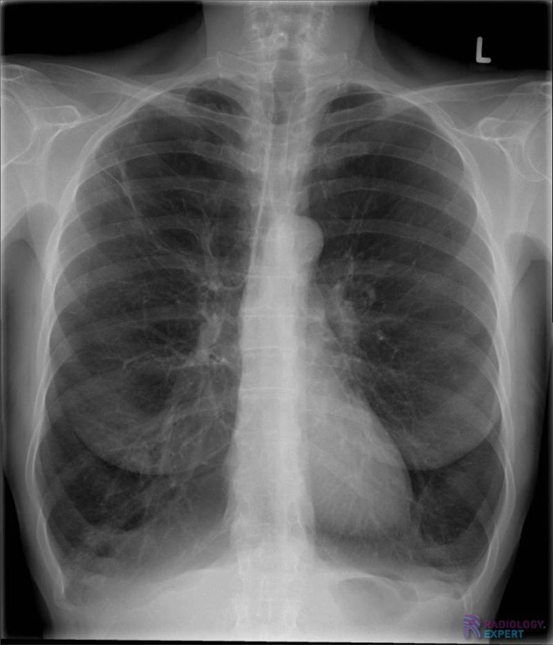 Chest X-ray