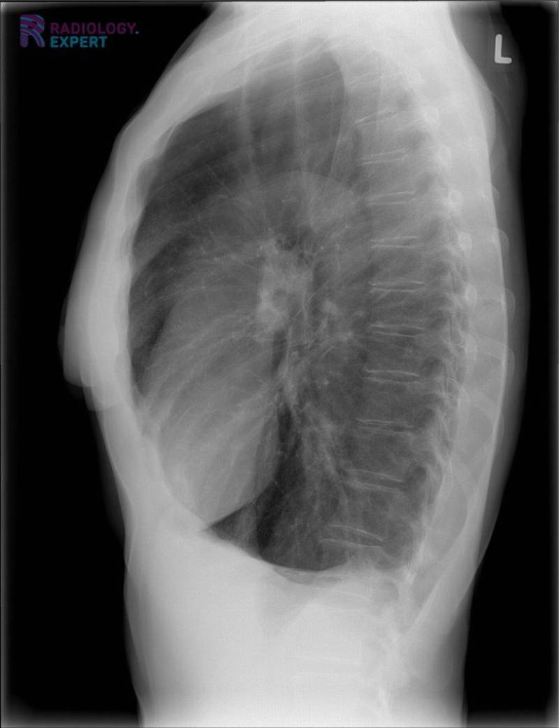 Chest X-ray