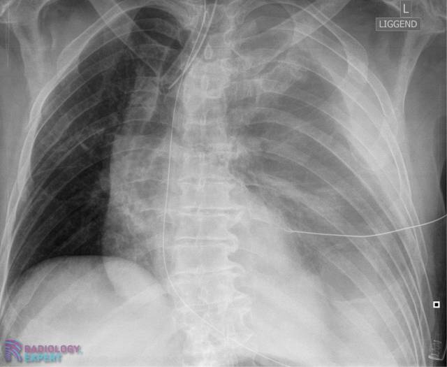 Chest X-ray
