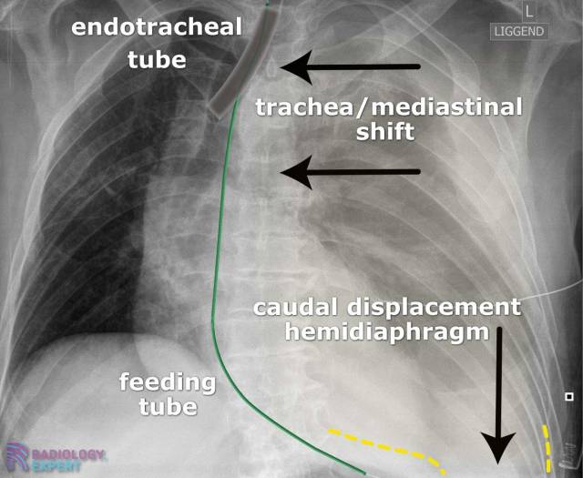 Chest X-ray
