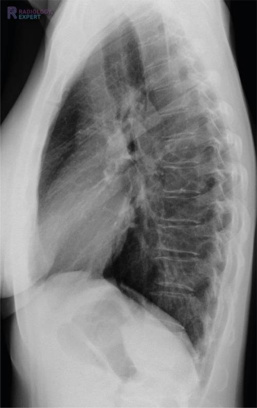 X-Thorax