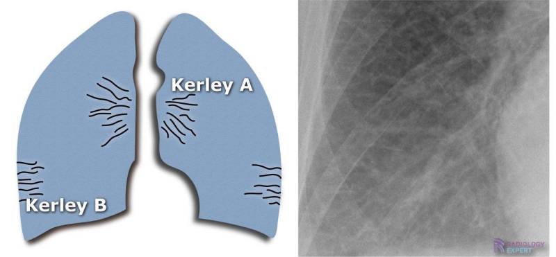 X-Thorax
