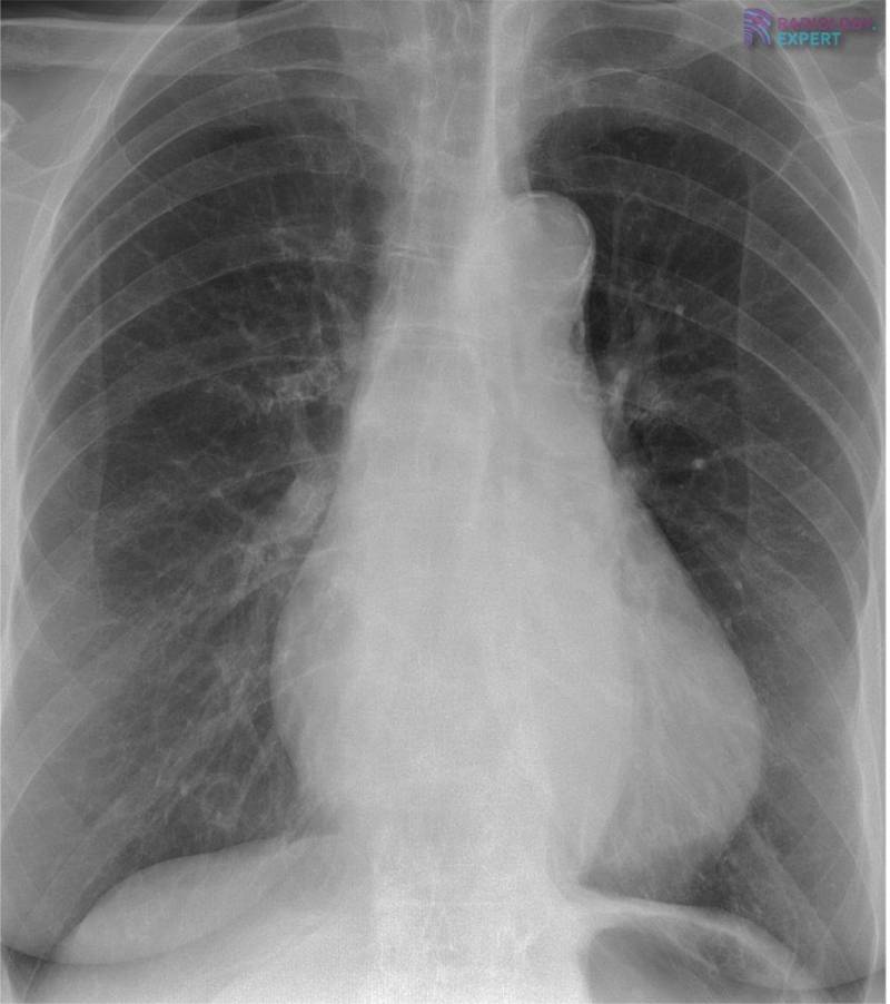X-Thorax