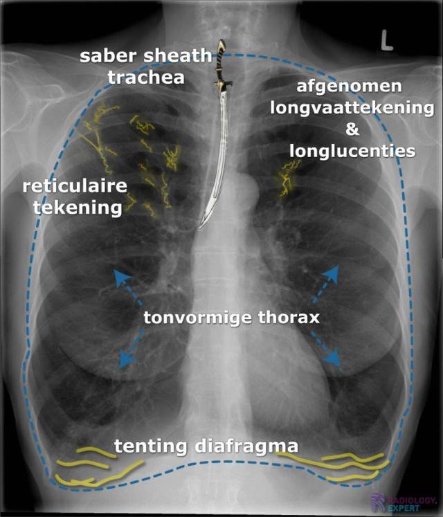 X-Thorax