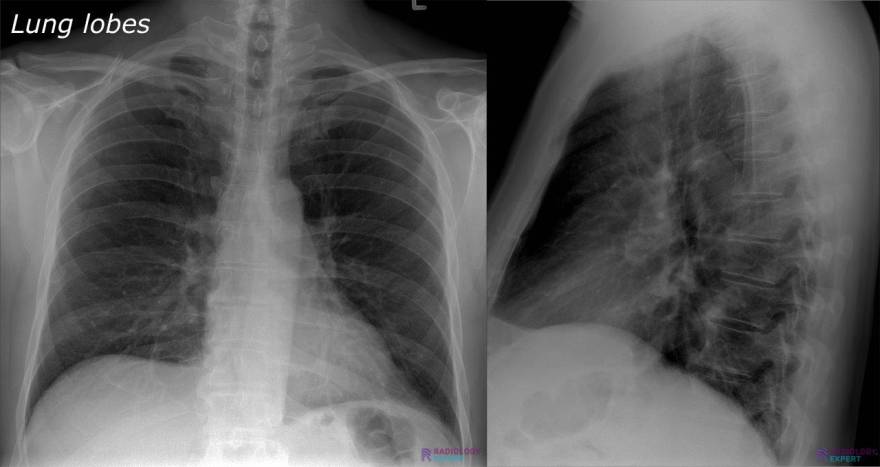 Chest X-ray