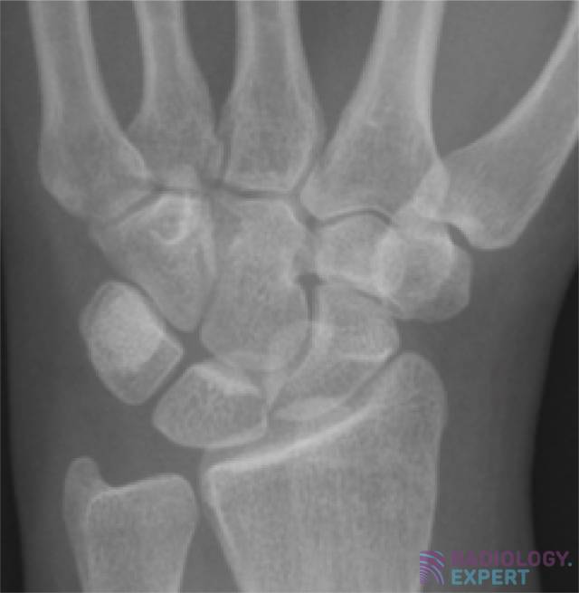 Wrist Joint X Ray