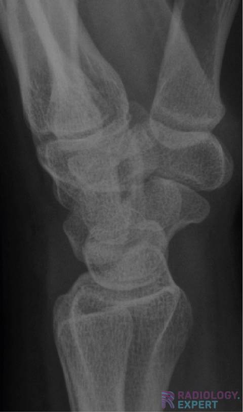 X Ray Wrist Normal 30 Left Wrist X Ray Stock Photos, High Res