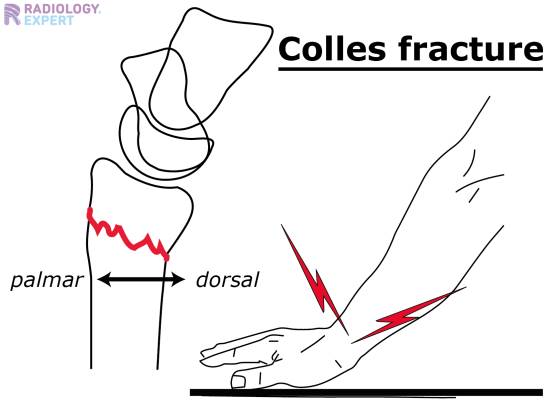 Fractura Colles Fracture Tratamiento Fracturas Distal Radius ...