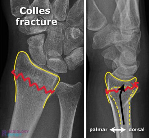 Smith Vs Colles Fracture