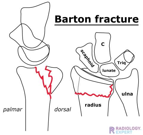 Barton Fracture