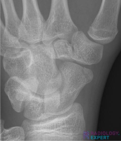 scaphoid tubercle xray