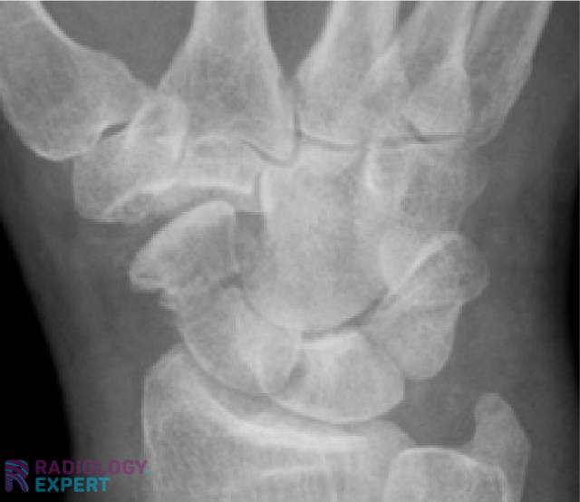 Smith Fracture X Ray Femur Fracture Radiology At St. Vincent's