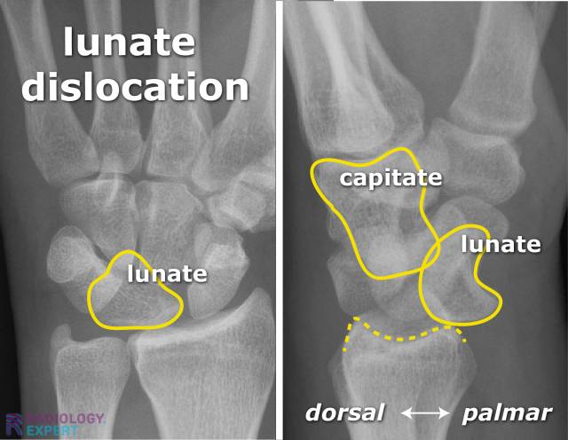Lunate Dislocation Pie Sign
