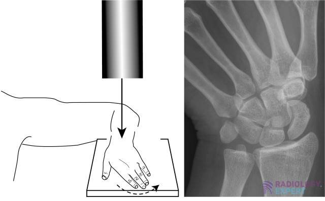 X Ray Wrist Anatomy X Ray Of The Wrist Radlines.org